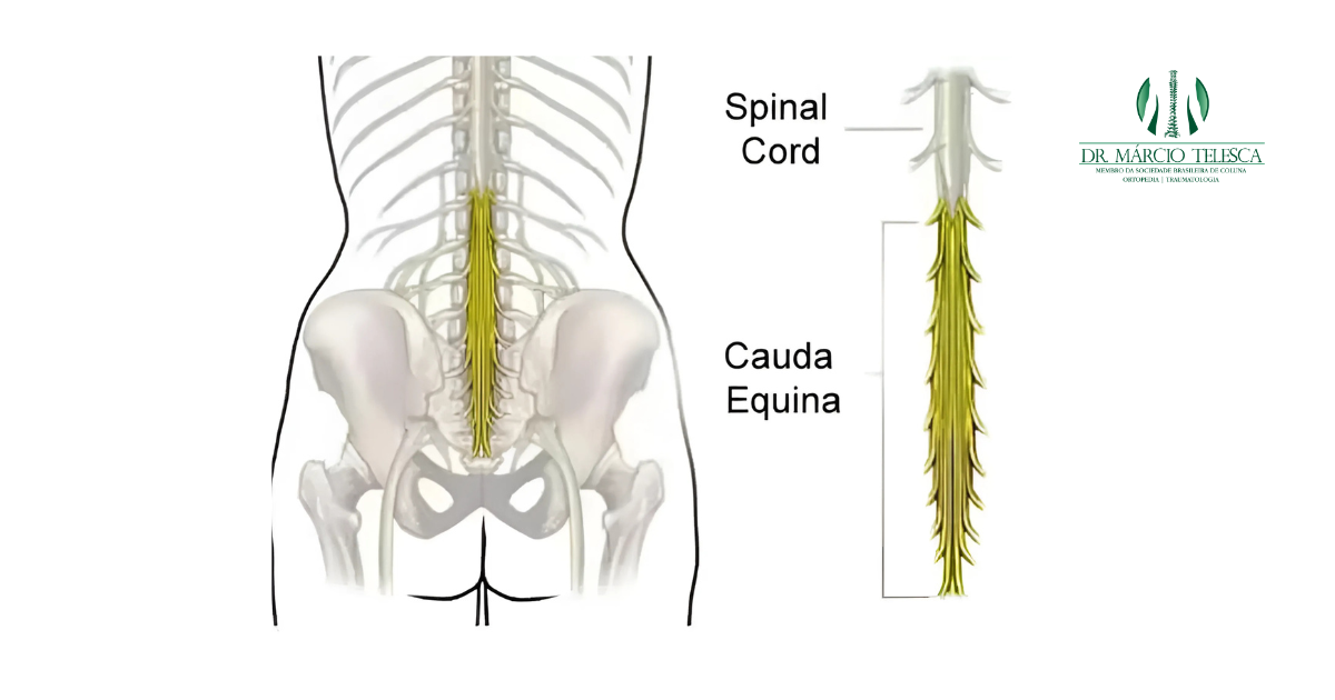 Síndrome da Cauda Equina: Urgência Cirúrgica e Prognóstico Neurológico ...