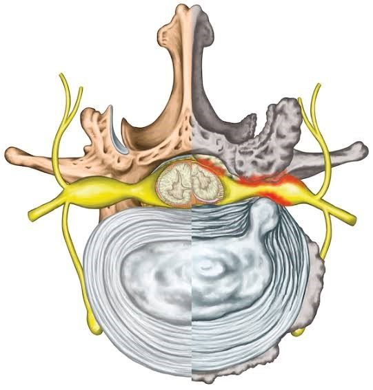 DOENÇA DO DISCO CERVICAL - Dr. Márcio Telesca - Especialista em ...